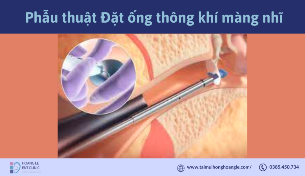 Phẫu thuật đặt ống thông khí màng nhĩ - Phòng Khám Tai Mũi Họng Hoàng Lê
