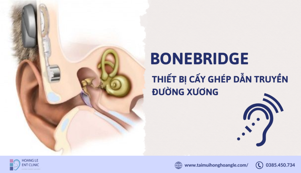 Thiết bị cấy ghép dẫn truyền đường xương BONEBRIDGE - Phòng Khám Tai Mũi Họng Hoàng Lê